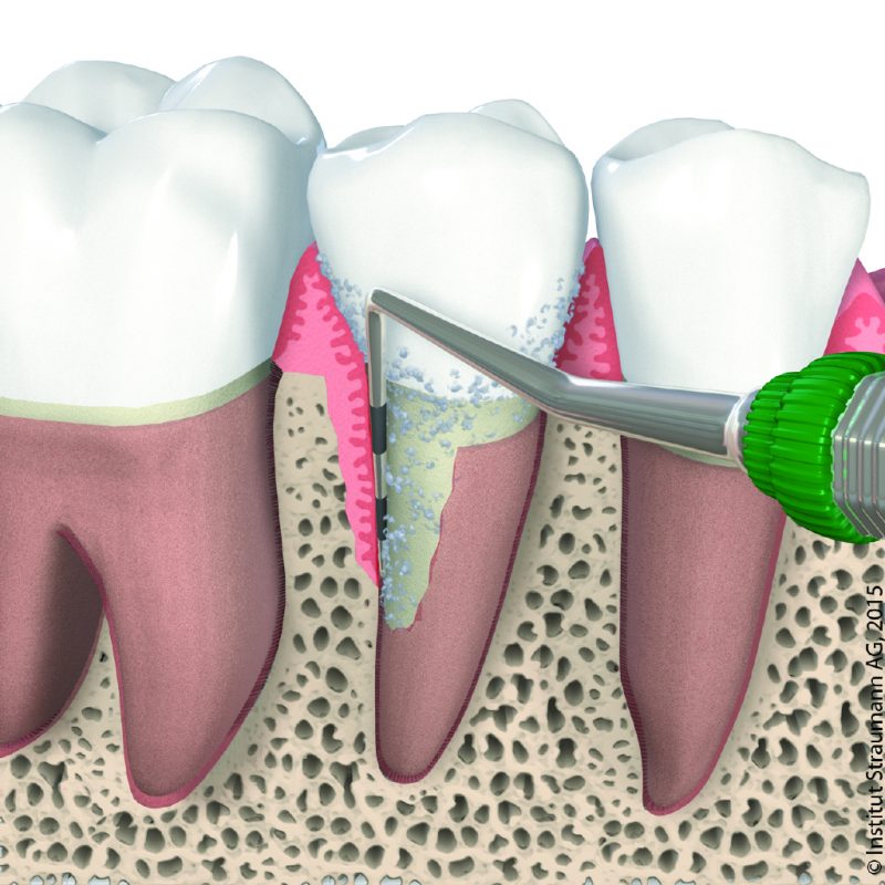 Zahnhalteapparat & Parodontitis-Behandlung in Herrenberg